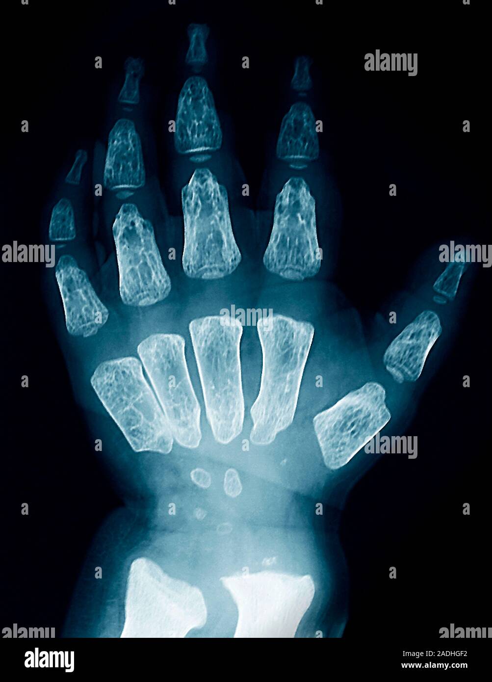 Hurler syndrome. Coloured X-ray of the hand of a 28 month old child ...