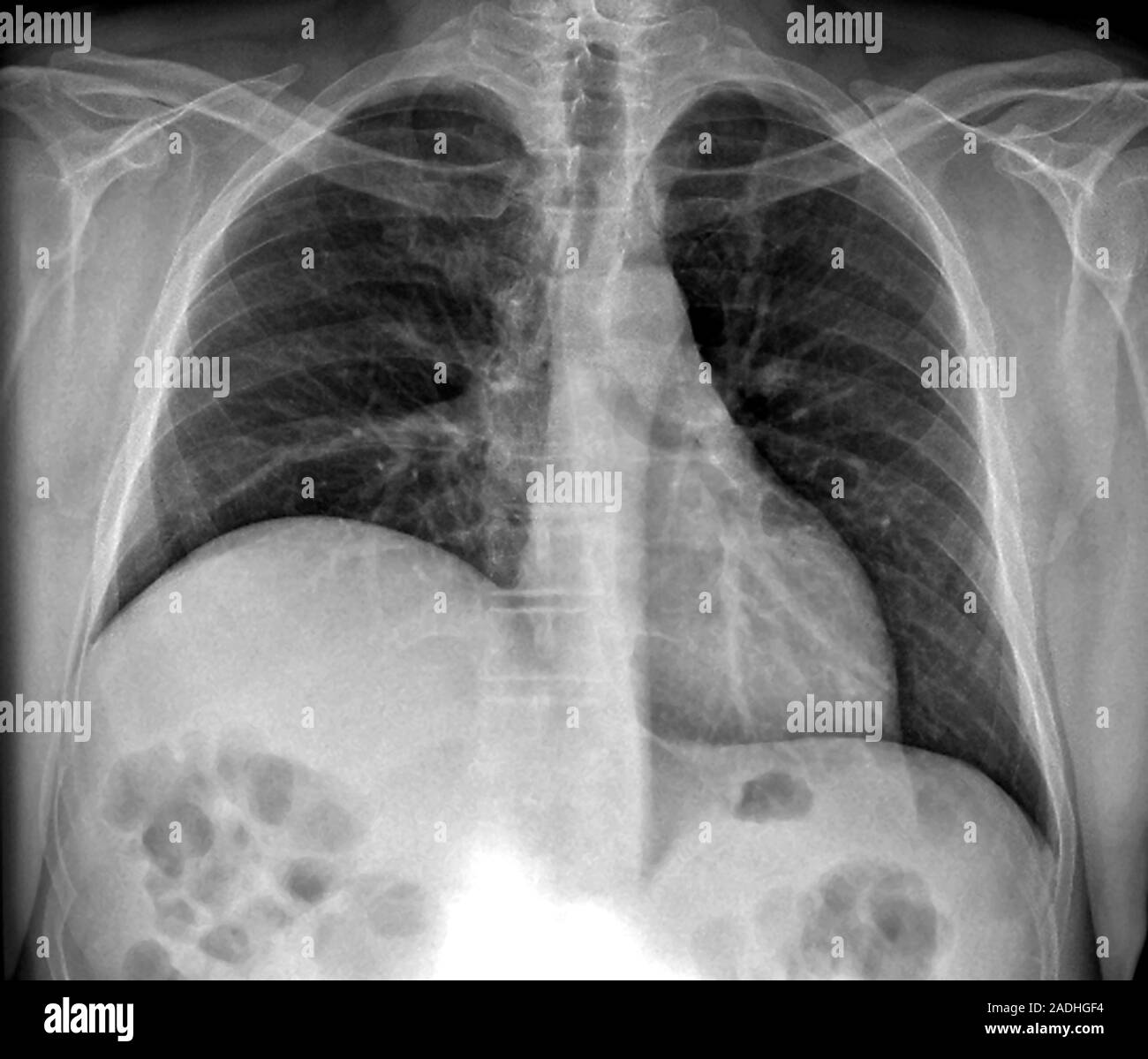 Enlarged liver. X-ray of the chest of a 55 year old patient with an ...