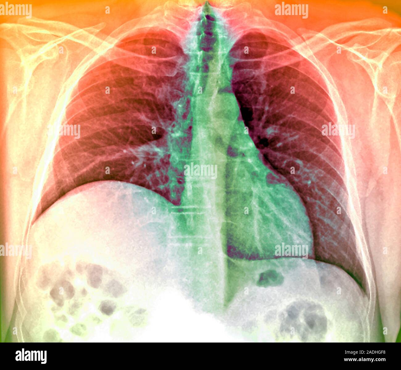 Enlarged liver. Coloured X-ray of the chest of a 55 year old patient ...