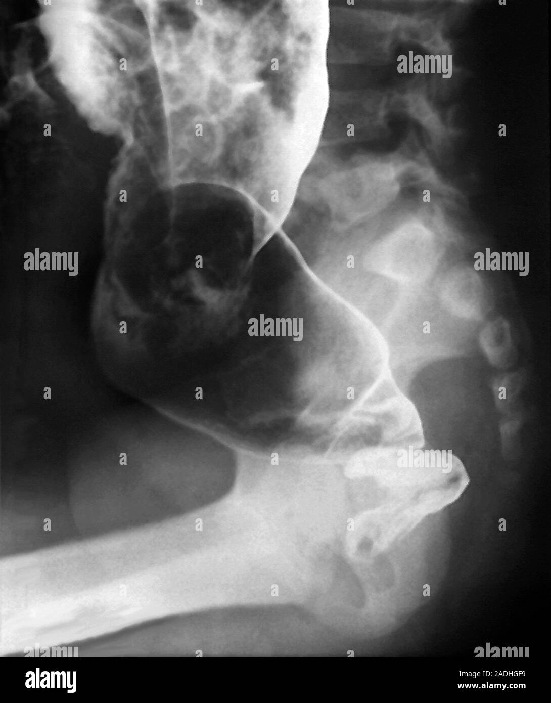 Hirschsprung's disease. Barium X-ray of the abdomen of a child with ...