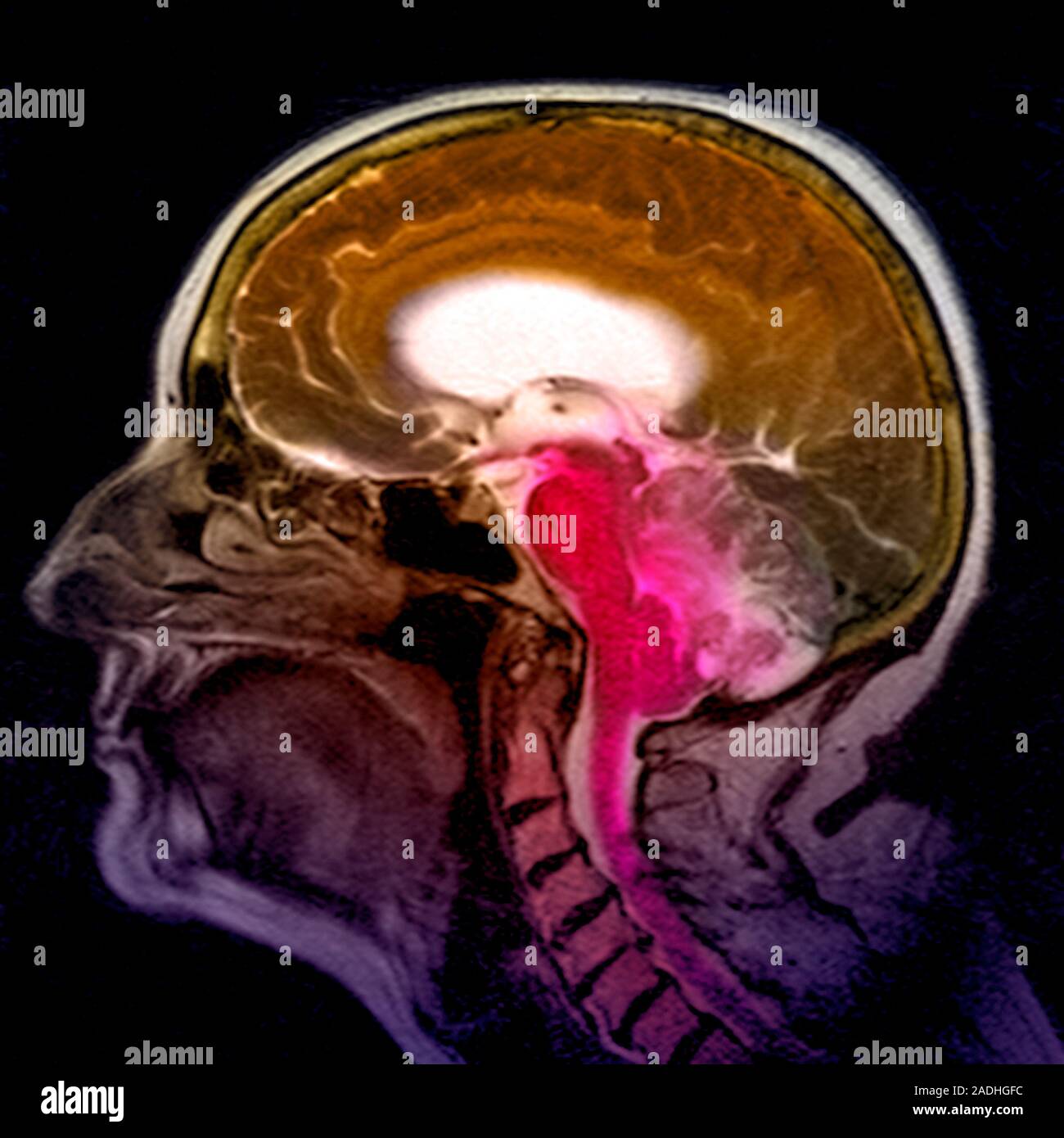 Haemangioblastoma brain tumour. Coloured magnetic resonance imaging (MRI) scan of a sagittal ...