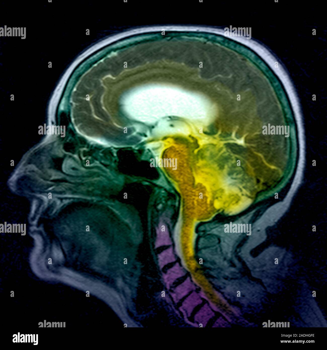 Haemangioblastoma brain tumour. Coloured magnetic resonance imaging (MRI) scan of a sagittal ...
