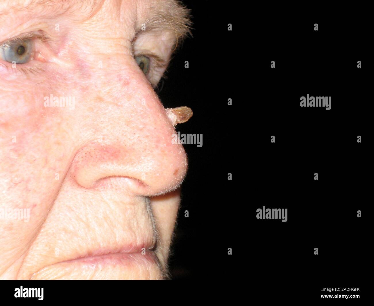 MODEL RELEASED. Cutaneous horn on an elderly woman's nose. A cutaneous ...