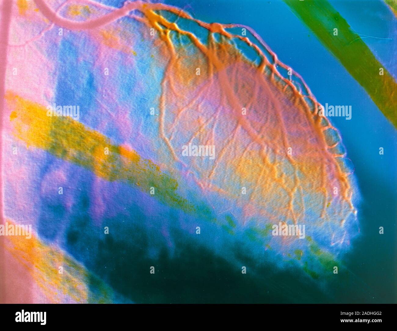 Coloured arteriograph (angiograph) of the human heart, showing multiple ...