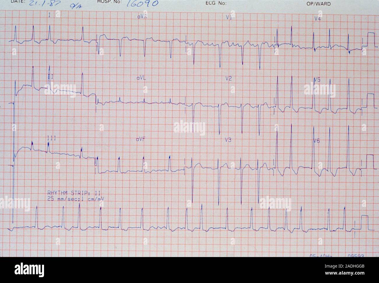 Electrocardiogram (ECG) indicating aortic stenosis, left ventricular ...
