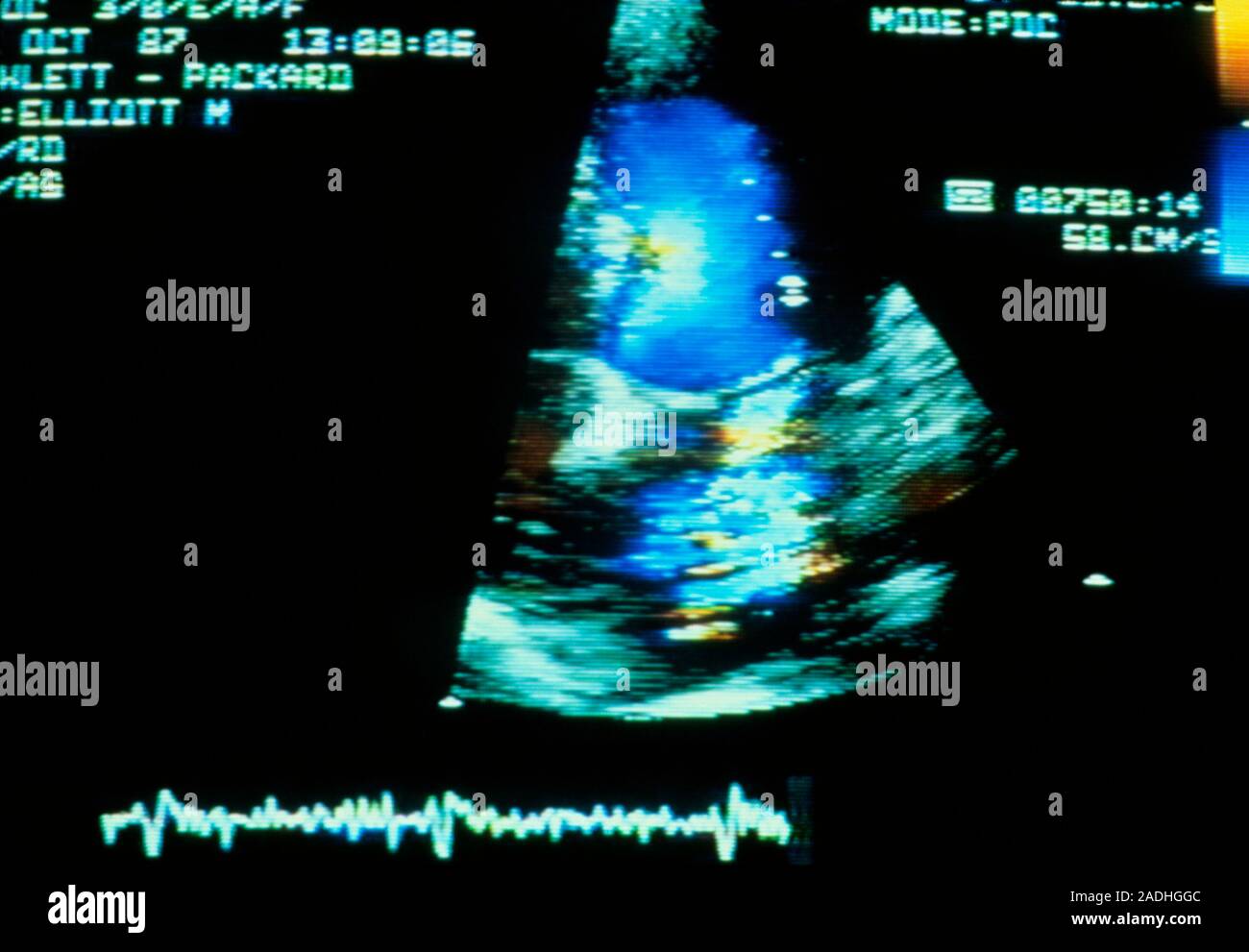 Colour echocardiogram (colour flow doppler map) of the human heart ...