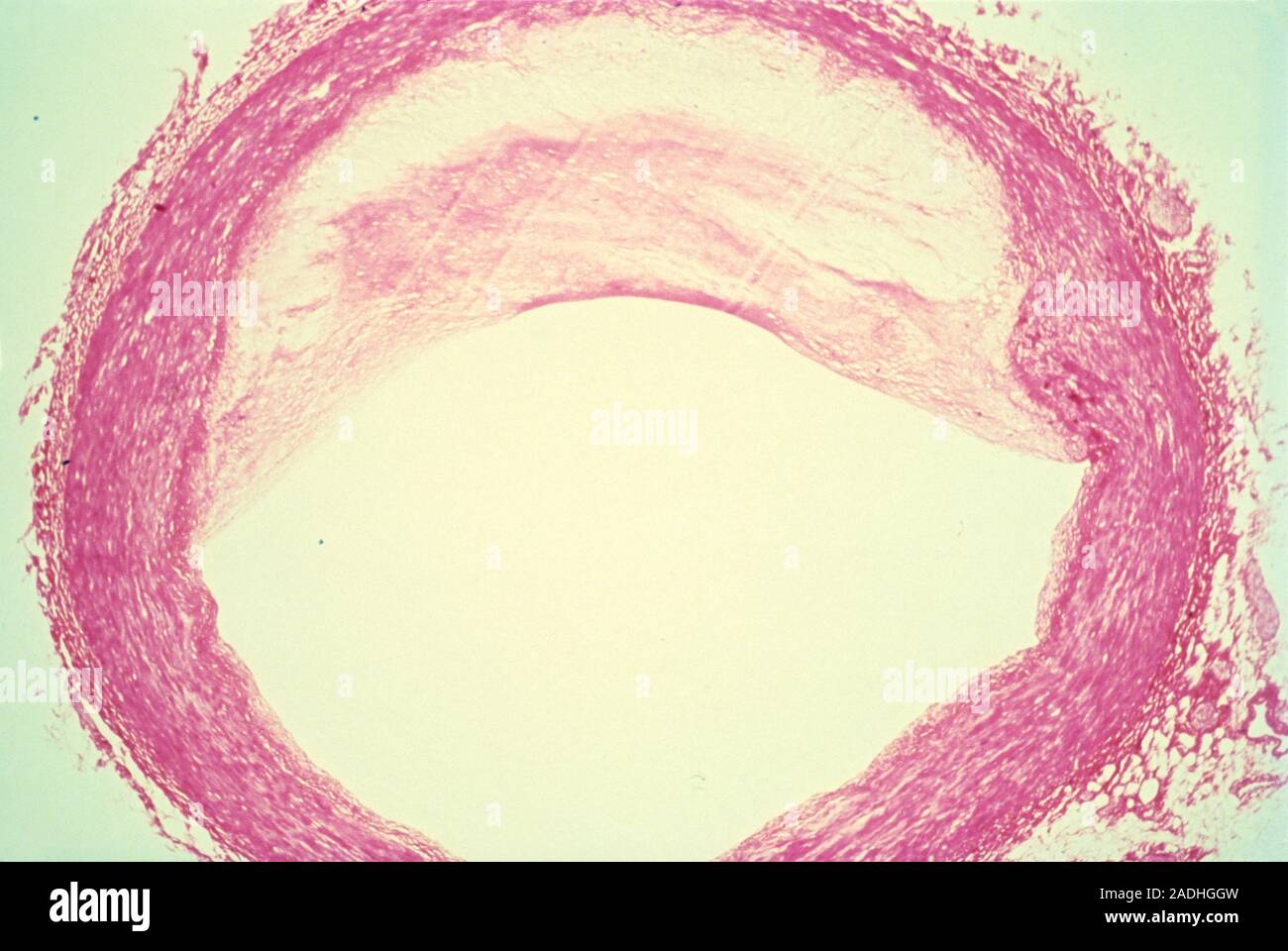 Light micrograph of a section through a human coronary artery, showing ...