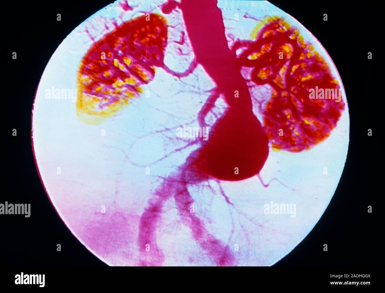 False-colour arteriogram revealing an abdominal aortic aneurysm, the ...