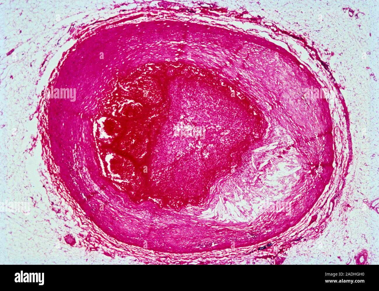 Light micrograph of a section through a human coronary artery: the ...