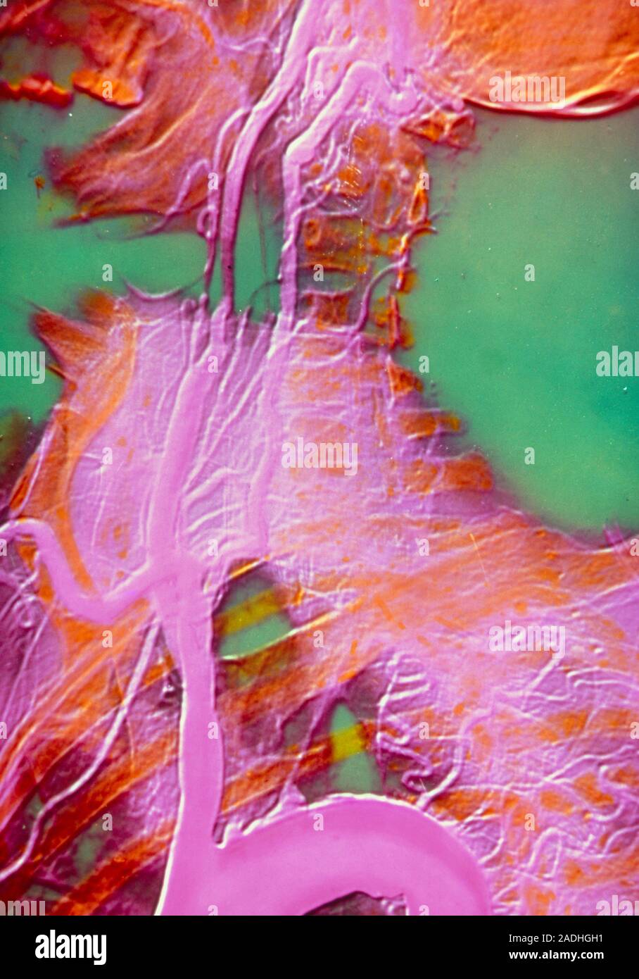 False-colour angiograph (arteriograph) of the neck & upper chest areas ...