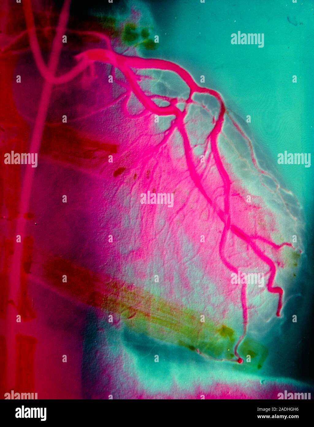 False Colour Angiogram Of The Human Heart Showing Stenosis Narrowing And Obstruction In