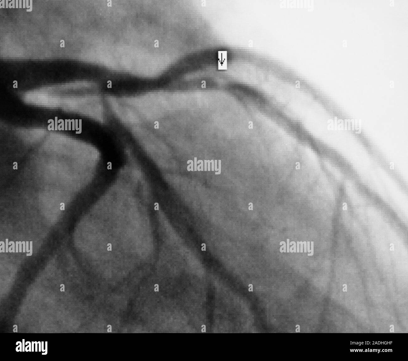 Angiogram (arteriogram) of an adult human heart showing a stenosis ...