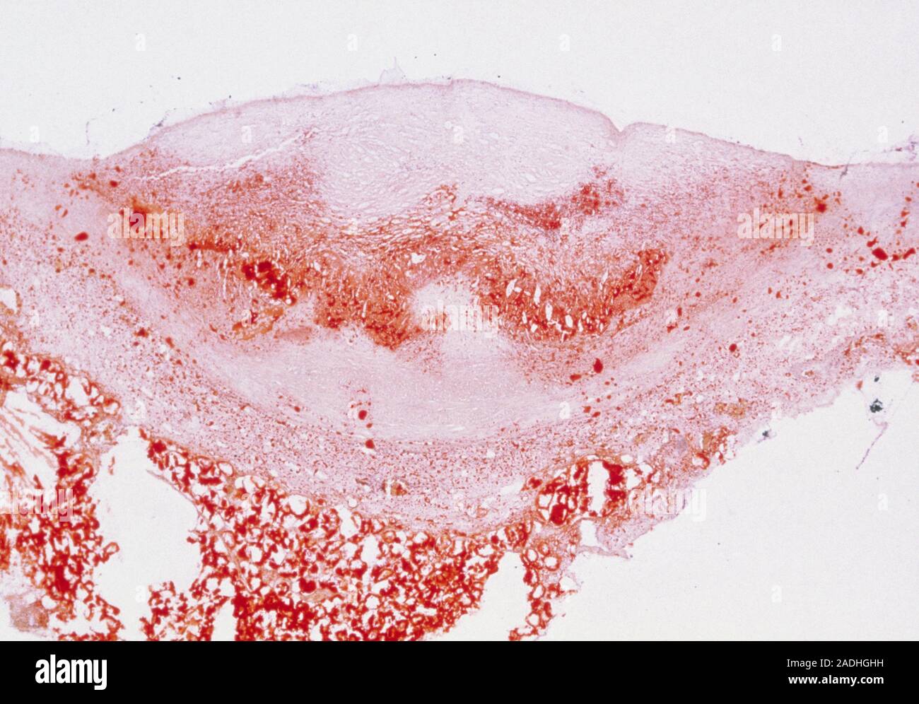 Light micrograph of a cross-section through an atheroma plaque in a ...