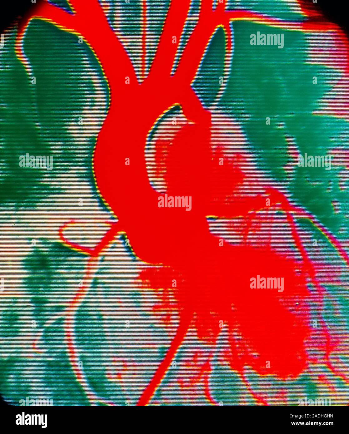 False-colour angiogram (arteriogram) of child aged 7 months showing an ...