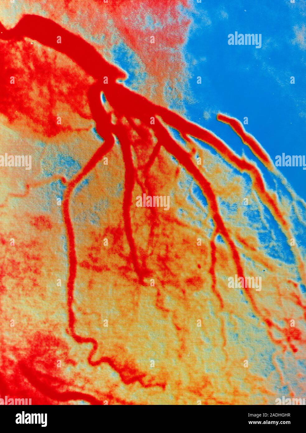 False-colour angiogram (arteriogram) of an adult human heart showing a ...