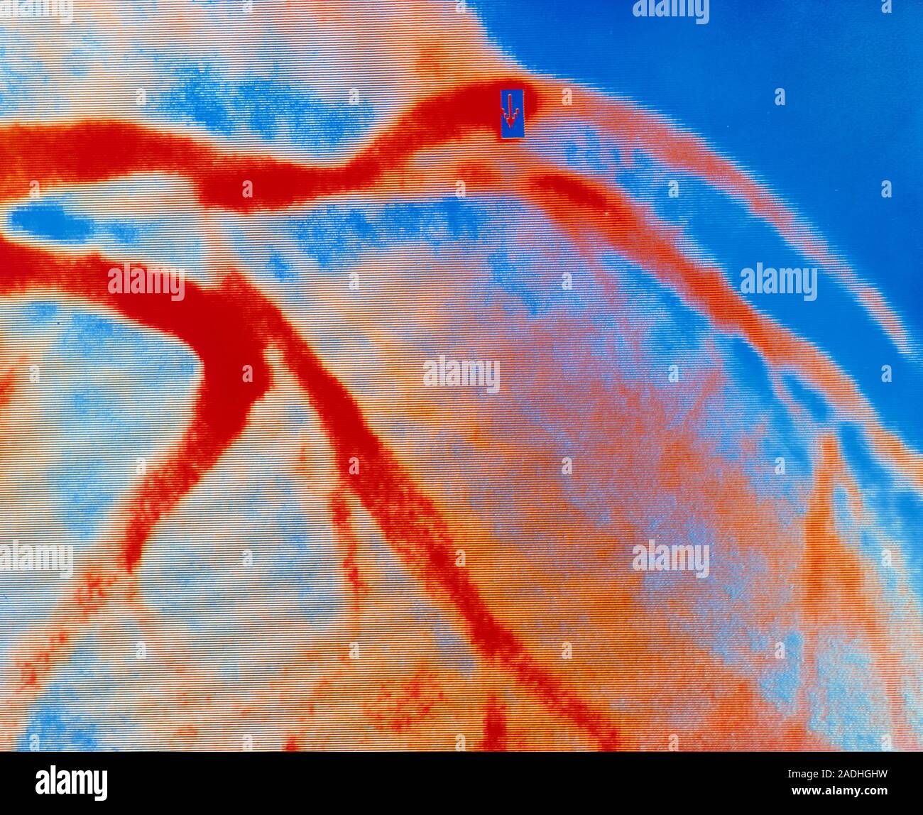 False-colour angiogram (arteriogram) of an adult human heart showing a ...