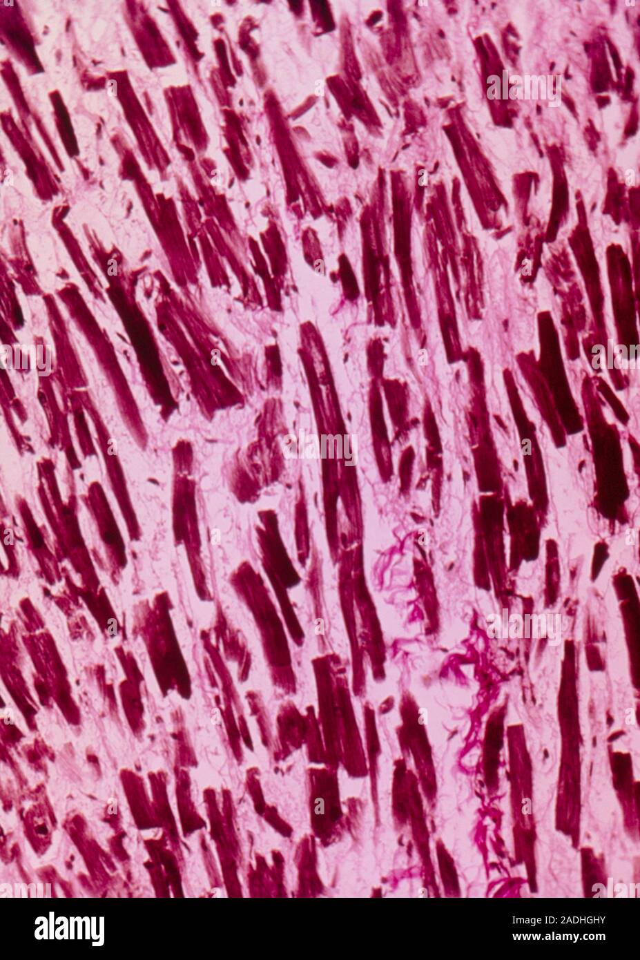 Fragmented heart muscle fibres following myocardial infarction: light ...