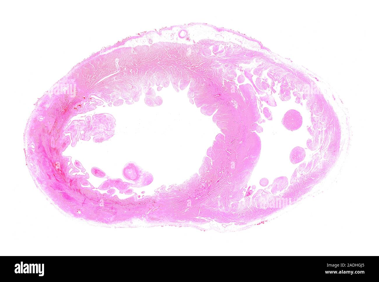 Infarcted left ventricle: light micrograph of a section through the ...