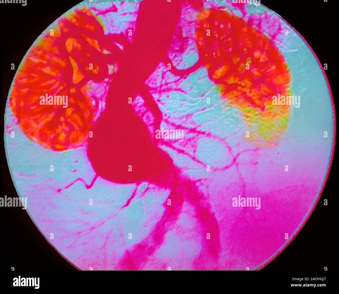 Arteriogram revealing an abdominal aortic aneurysm, the red, balloon ...