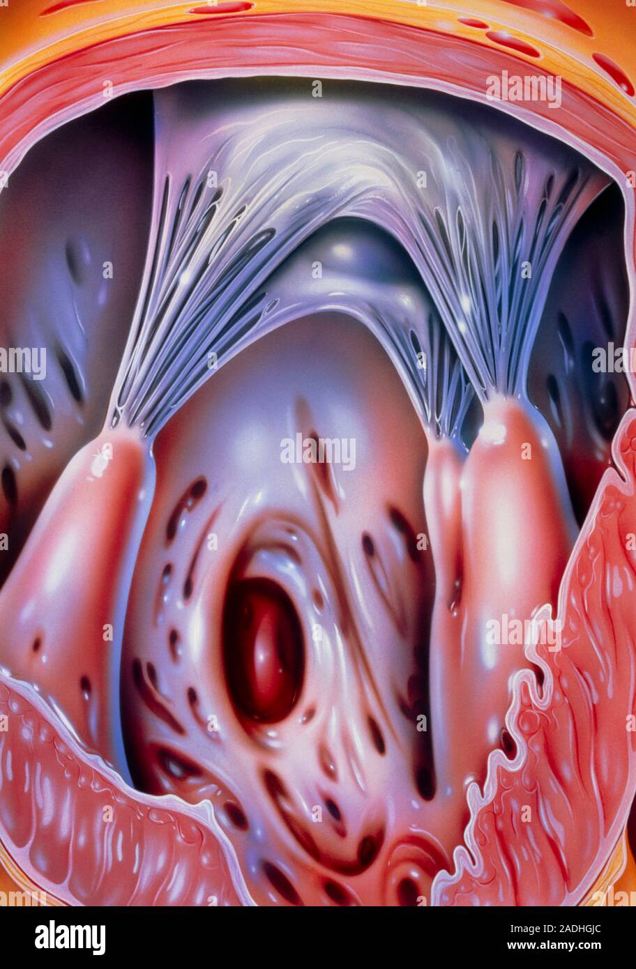 Illustration of a ventricular hole in the heart. This hole in the ...
