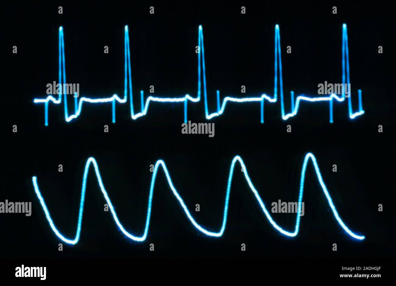 Coronary artery disease. Pair of electrocardiogram (ECG, top) and blood ...