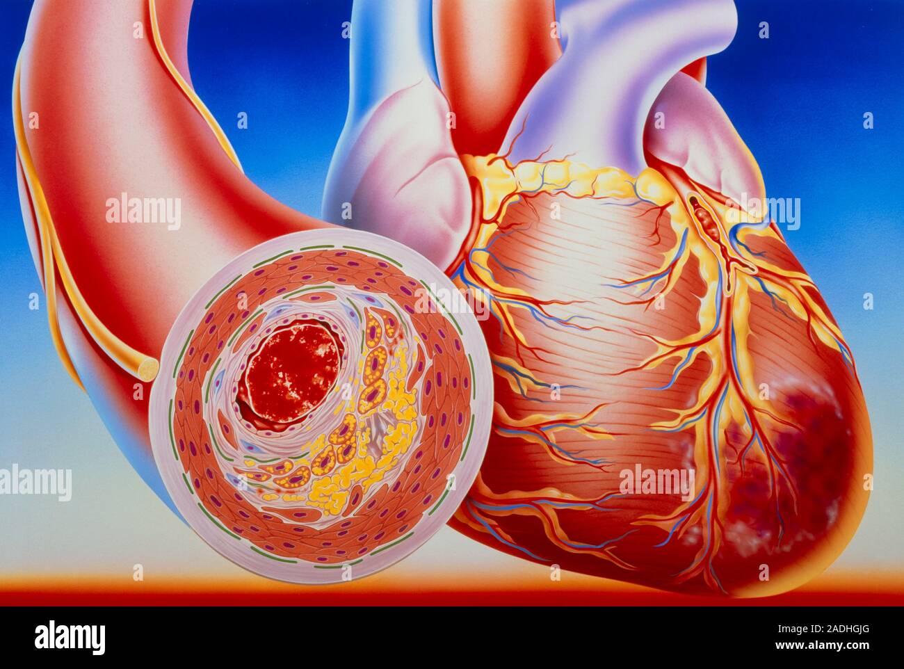 Heart attack and cholesterol. Illustration of myo- cardial infarction ...