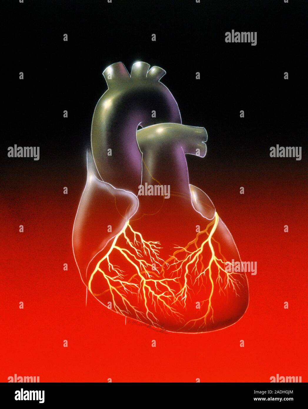 Angina pectoris. Illustration of a heart diseased with the cardiac ...