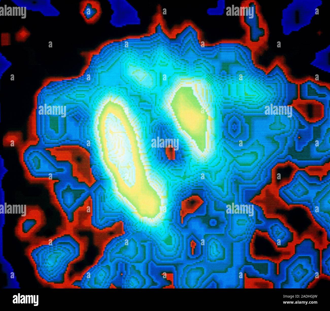 Heart after heart attack. False-colour computer enhanced gamma scan of ...