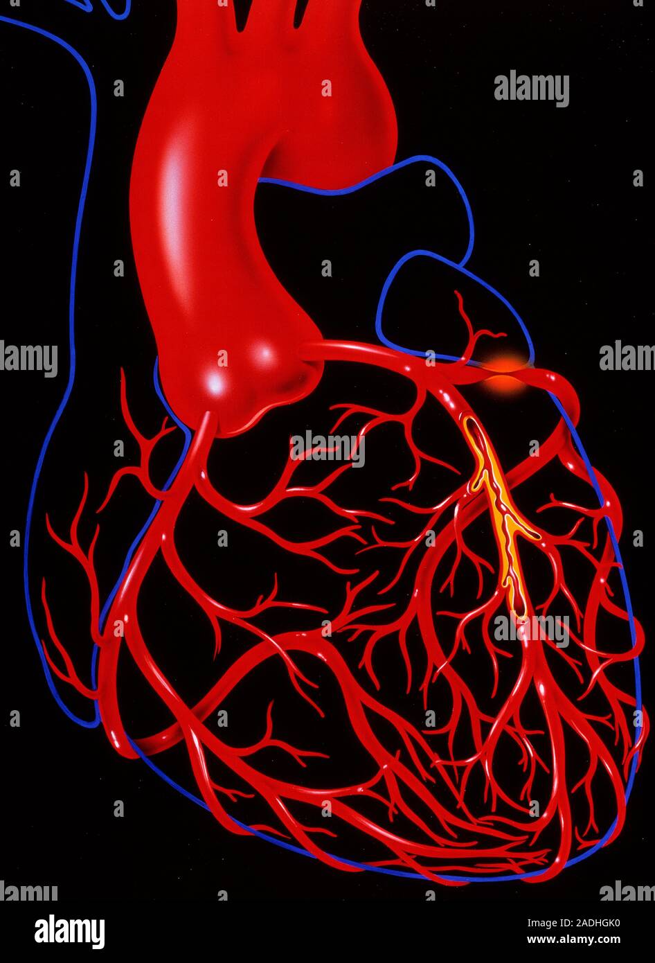Angina pectoris. Illustration of a heart diseased with the cardiac ...