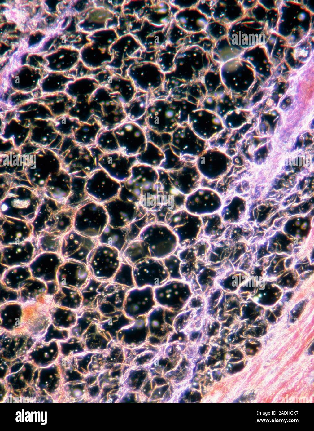 Fatty disease of heart. Light micrograph of human cardiac muscle ...