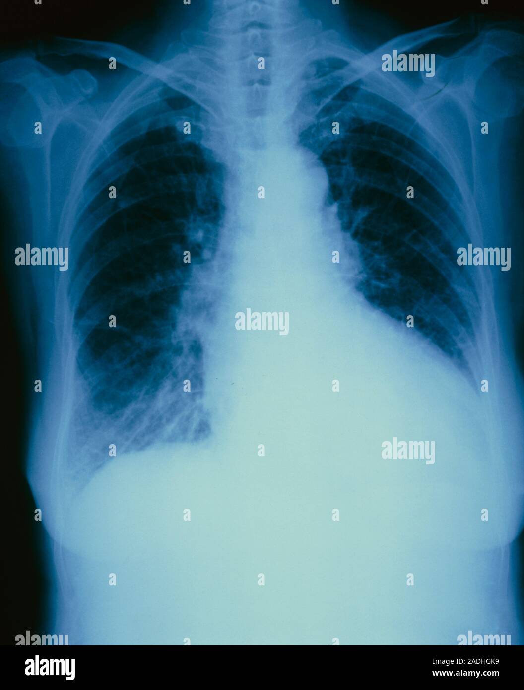 Ventricular failure. X-ray of the human chest showing left ventricular ...