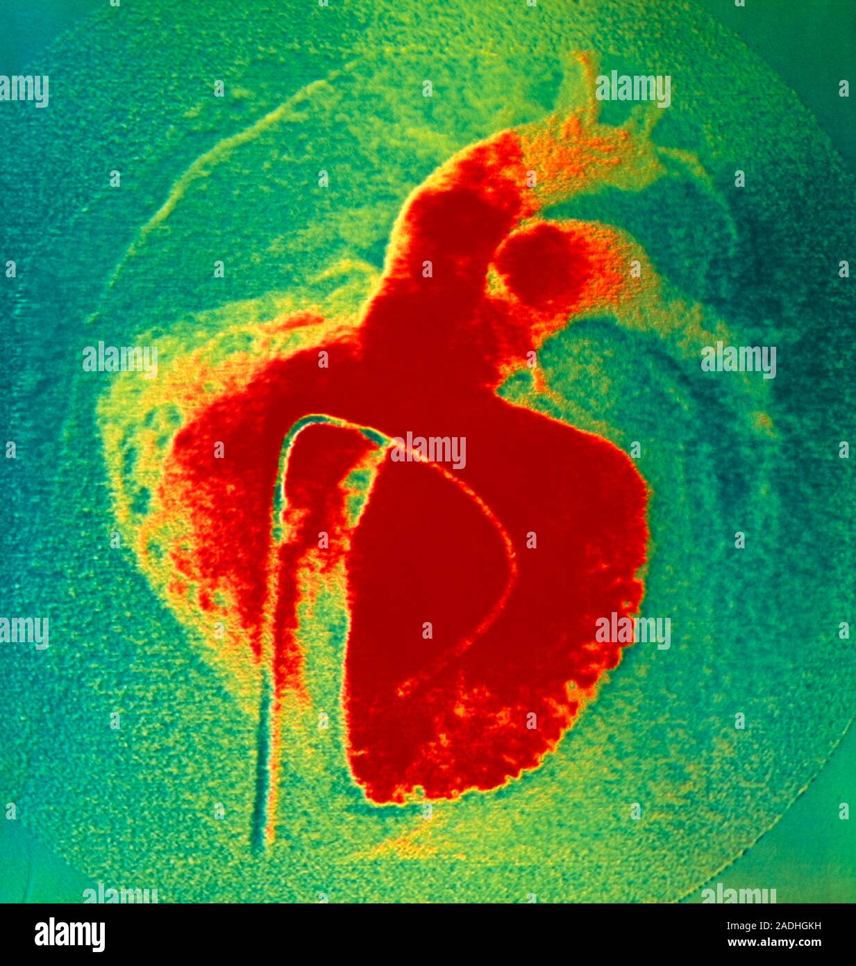 Congenital heart disease (hole in the heart). Angiogram of a ...