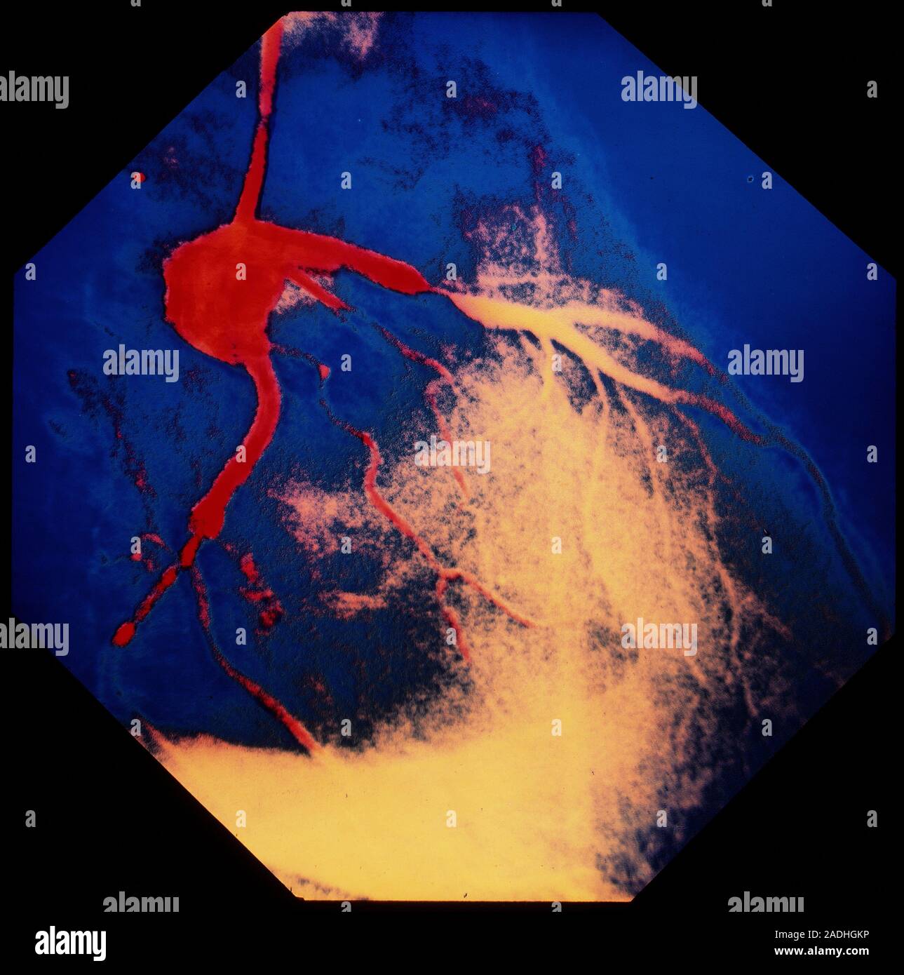 Heart disease. Coloured angiogram showing a severe stenosis (narrowing ...