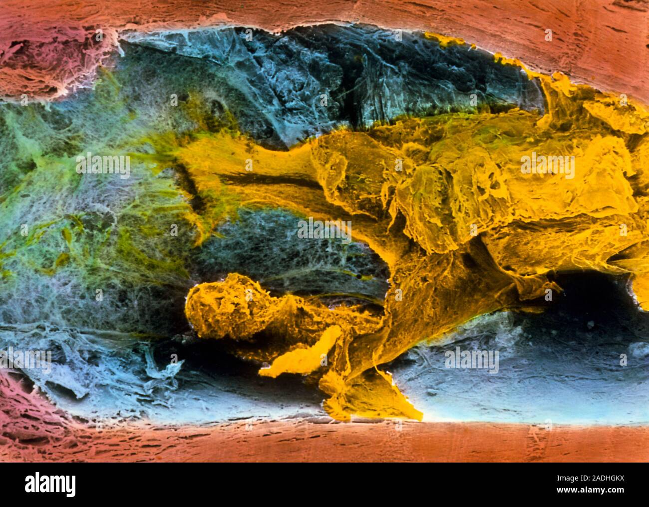 Atherosclerosis. Coloured Scanning Electron Micrograph (SEM) of a ...