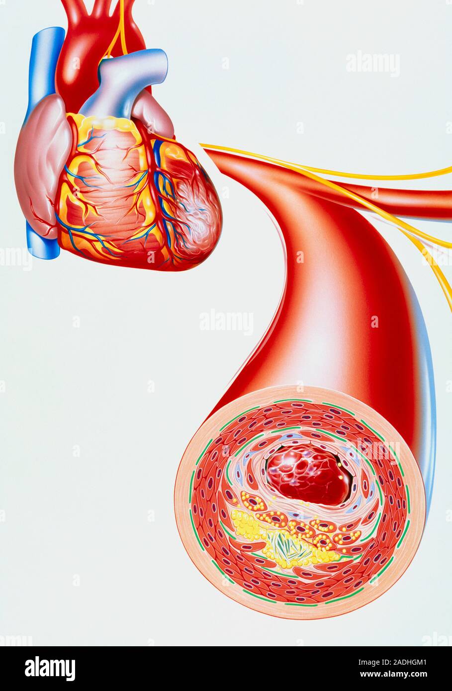 Coronary thrombosis. Illustration of the human heart and coronary ...