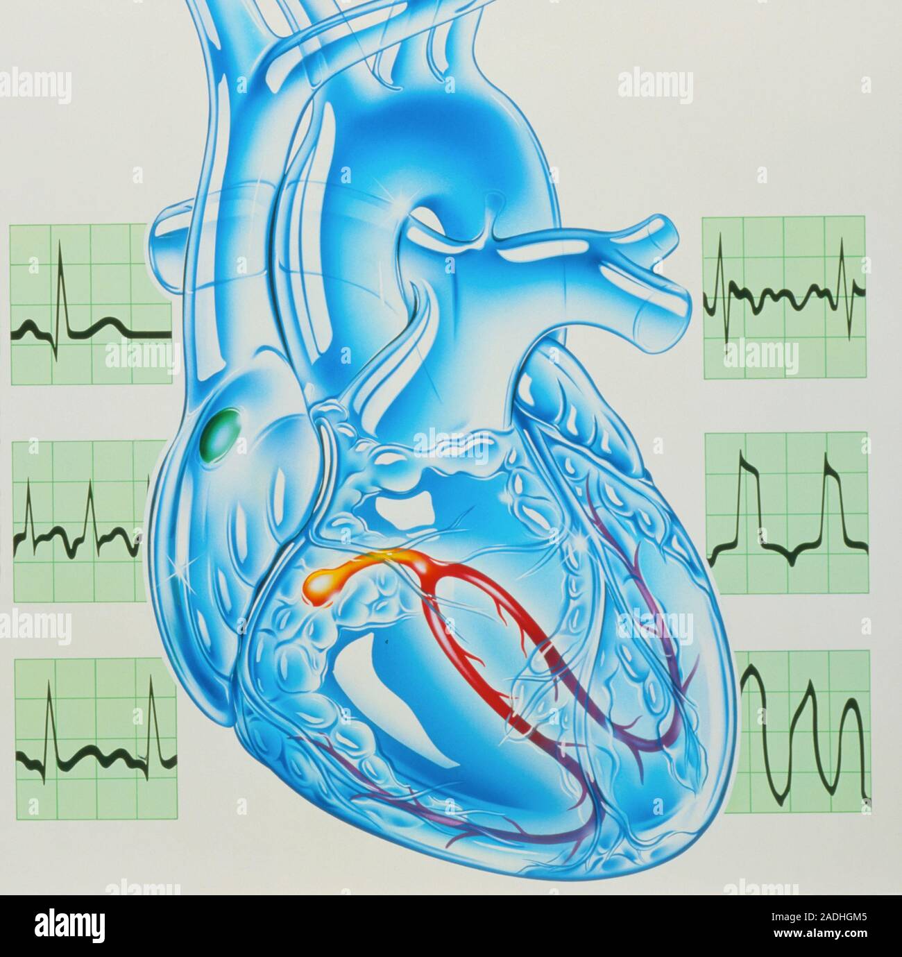 Cardiac arrhythmia. Artwork of a human heart with electrocardiogram ...