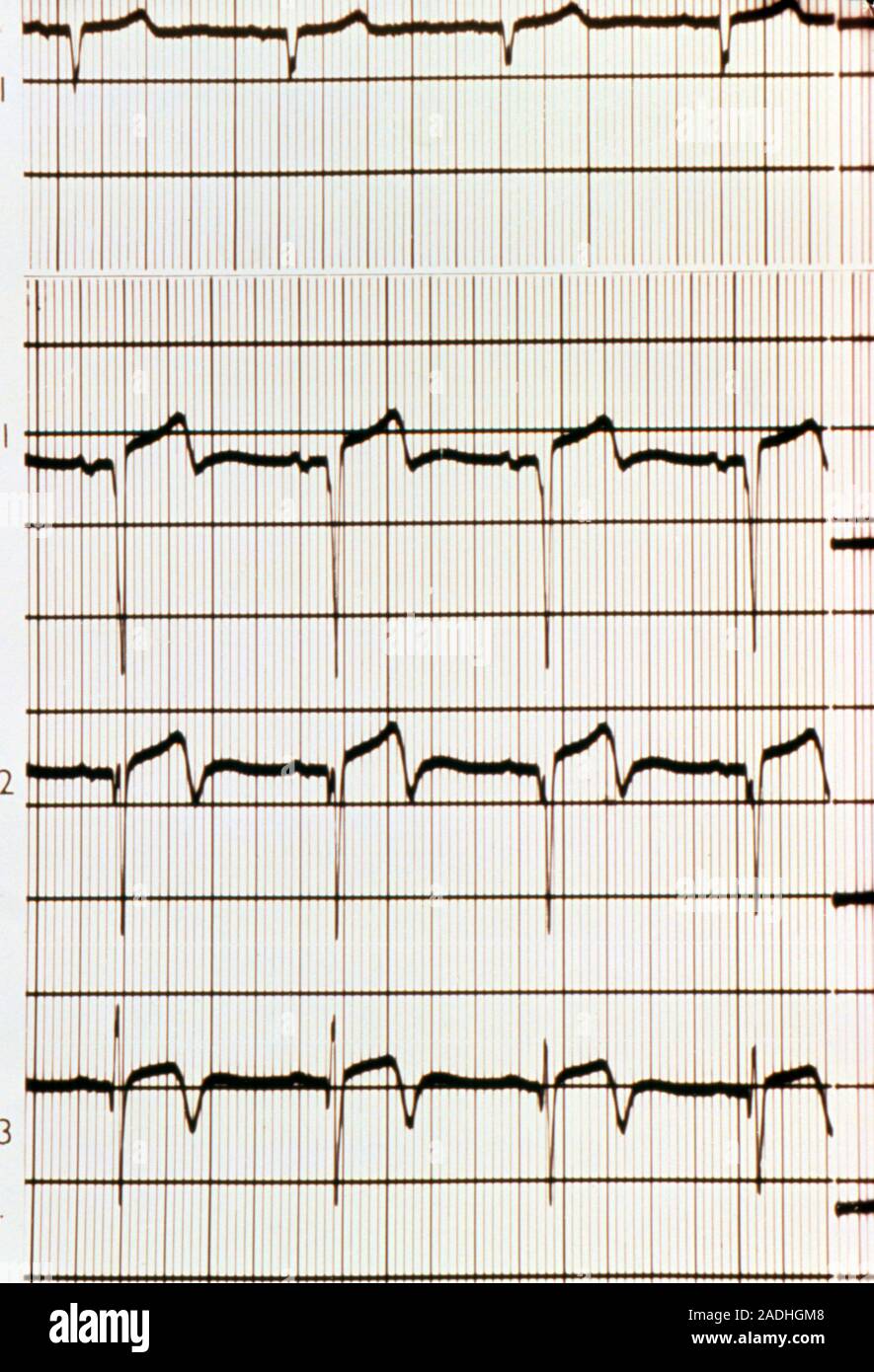 Heart attack ECG. Electrocardiogram (ECG) showing abnormal heartbeat ...