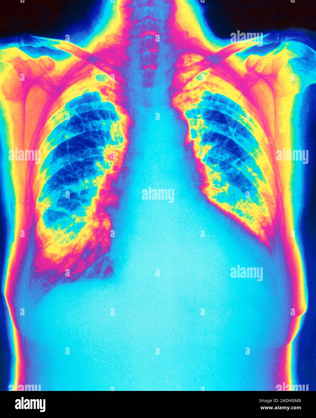 Ventricular failure. Coloured X-ray of the human chest showing left ...