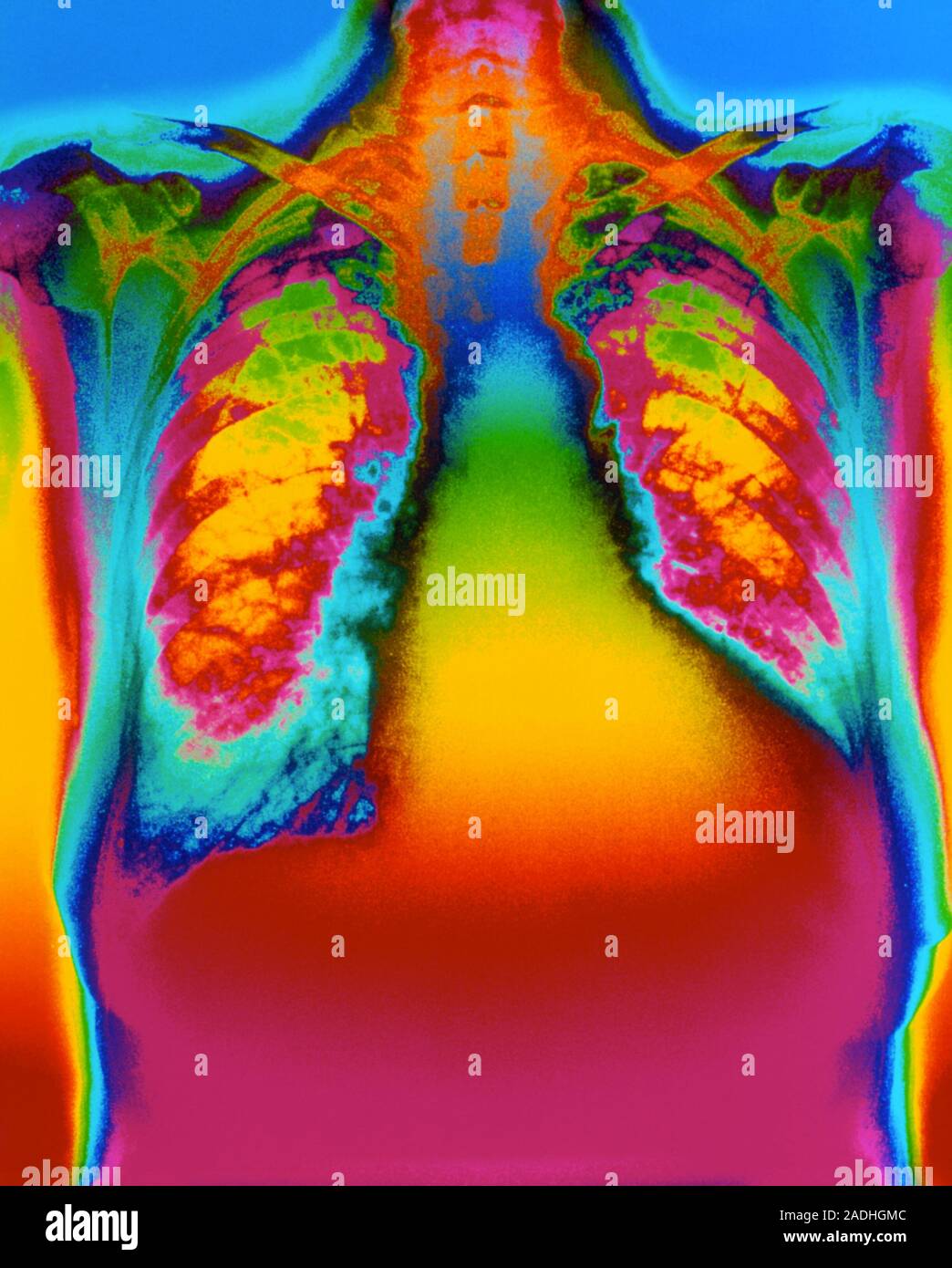 Ventricular failure. Coloured X-ray of the human chest showing left ...