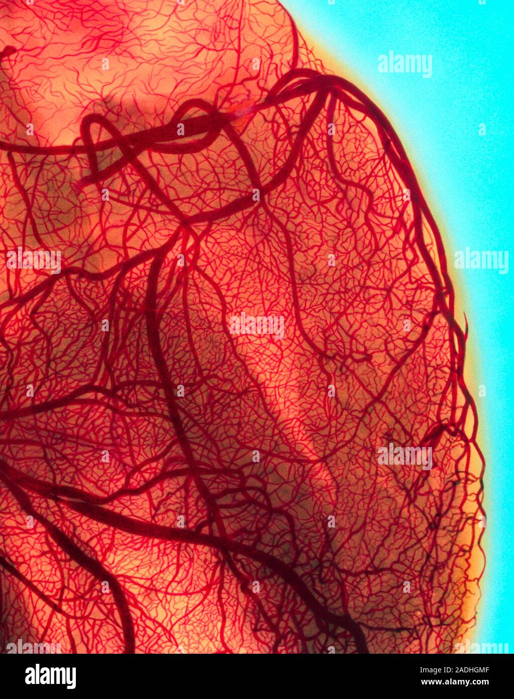 Stenosis. Colour-enhanced angiogram of the heart showing stenosis ...