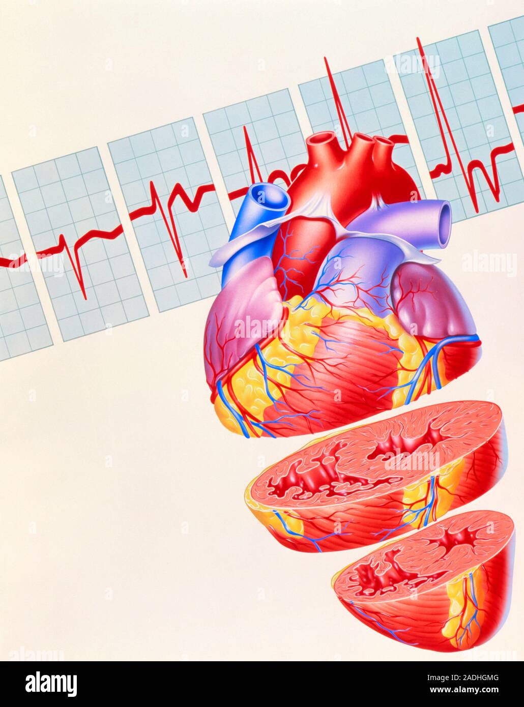 Heart failure. Cutaway illustration of a human heart and an ECG ...