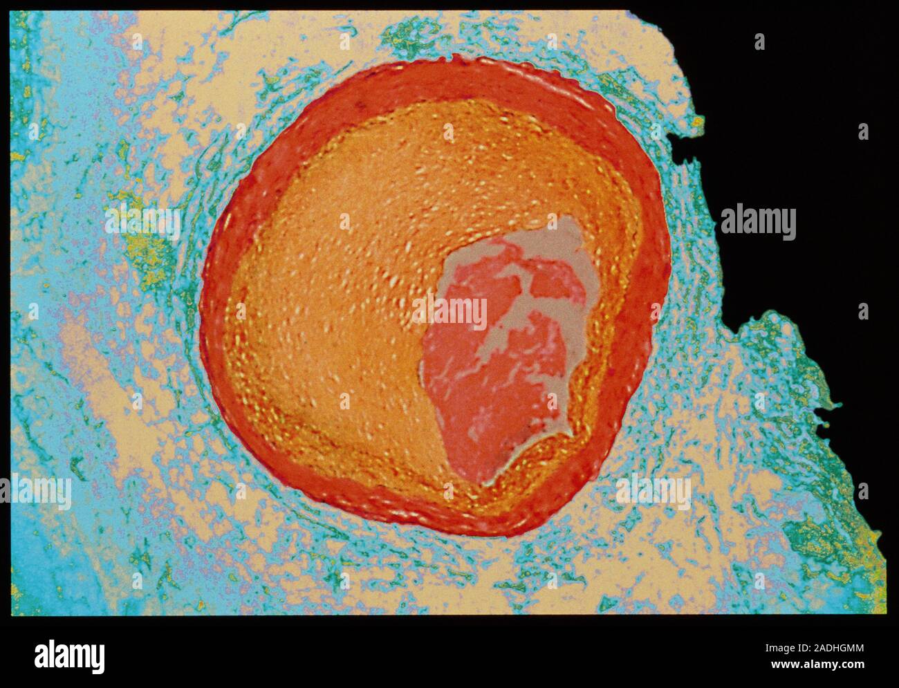 Blocked coronary artery. Computer coloured light micrograph of a cross ...