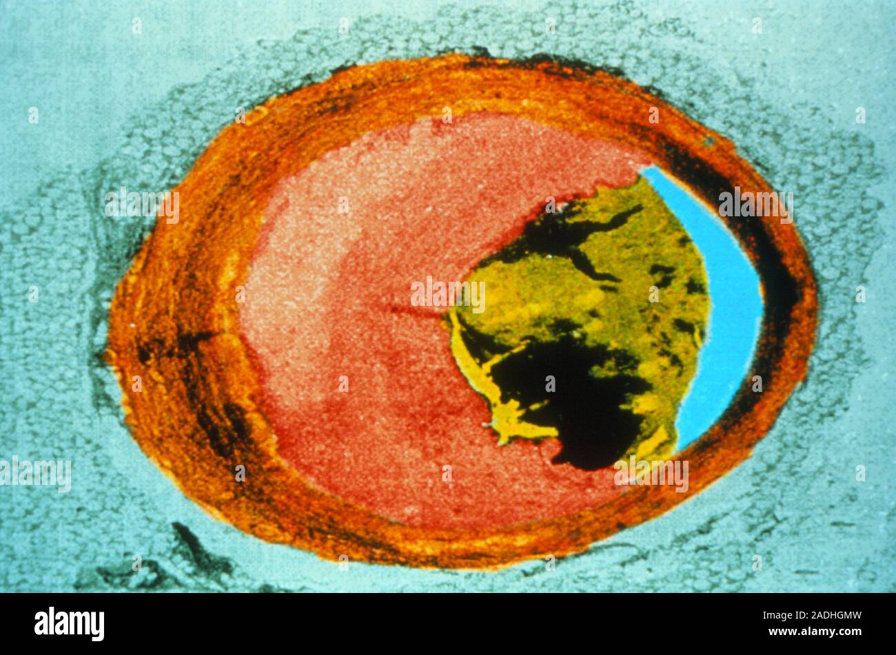Atherosclerosis. Coloured Scanning Electron Micro- graph (SEM) of a ...