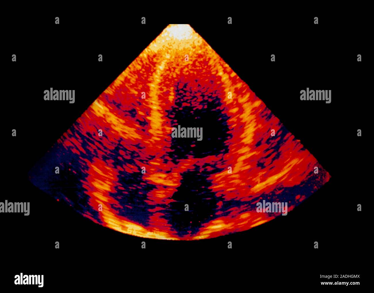 Enlarged heart. Coloured ultrasound image of the human heart showing ...