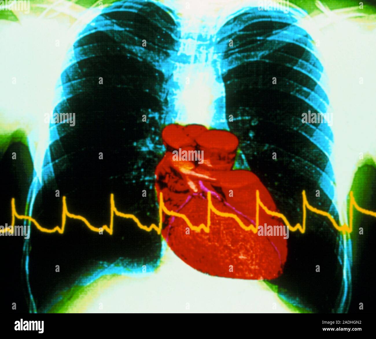 ECG trace in heart attack. Yellow electrocardio- graph (ECG) trace ...
