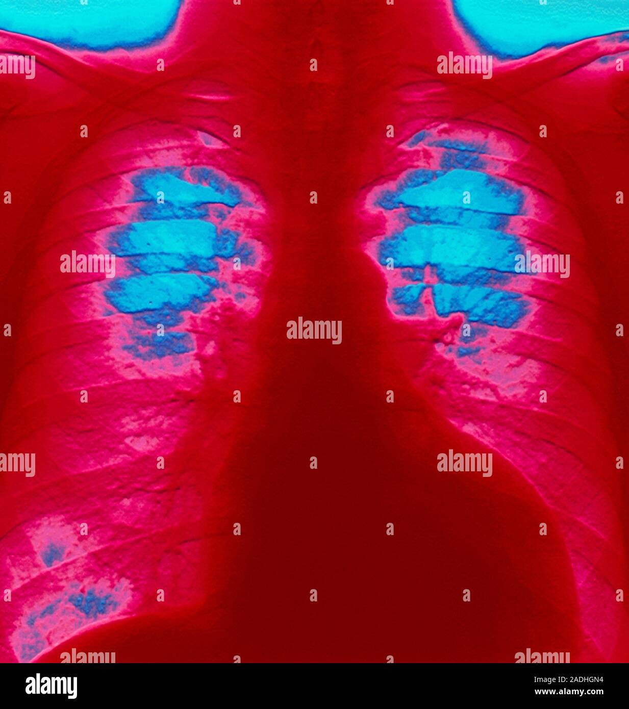Cardiomyopathy. Coloured chest X-ray of a patient suffering ...