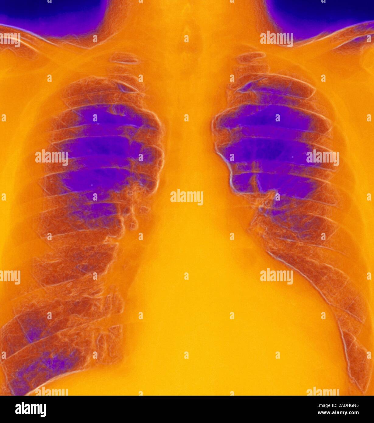 Cardiomyopathy. Coloured chest X-ray of a patient suffering ...