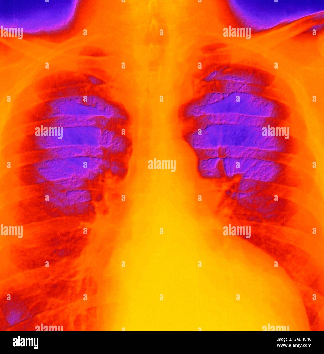 Cardiomyopathy. Coloured chest X-ray of a patient suffering ...