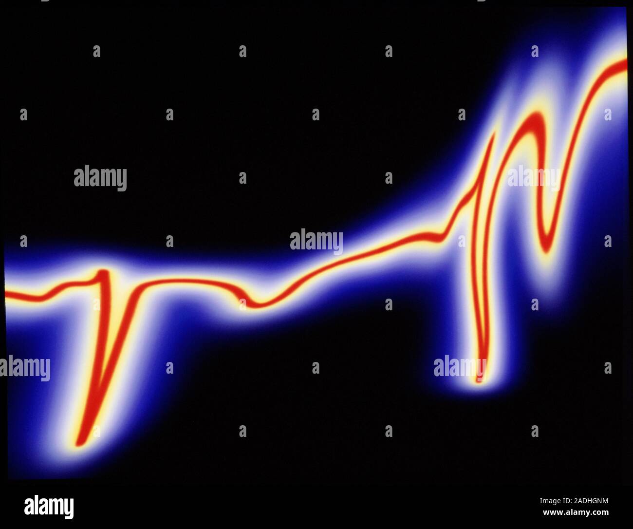 Irregular heartbeat. Computer-enhanced image of an electrocardiograph ...