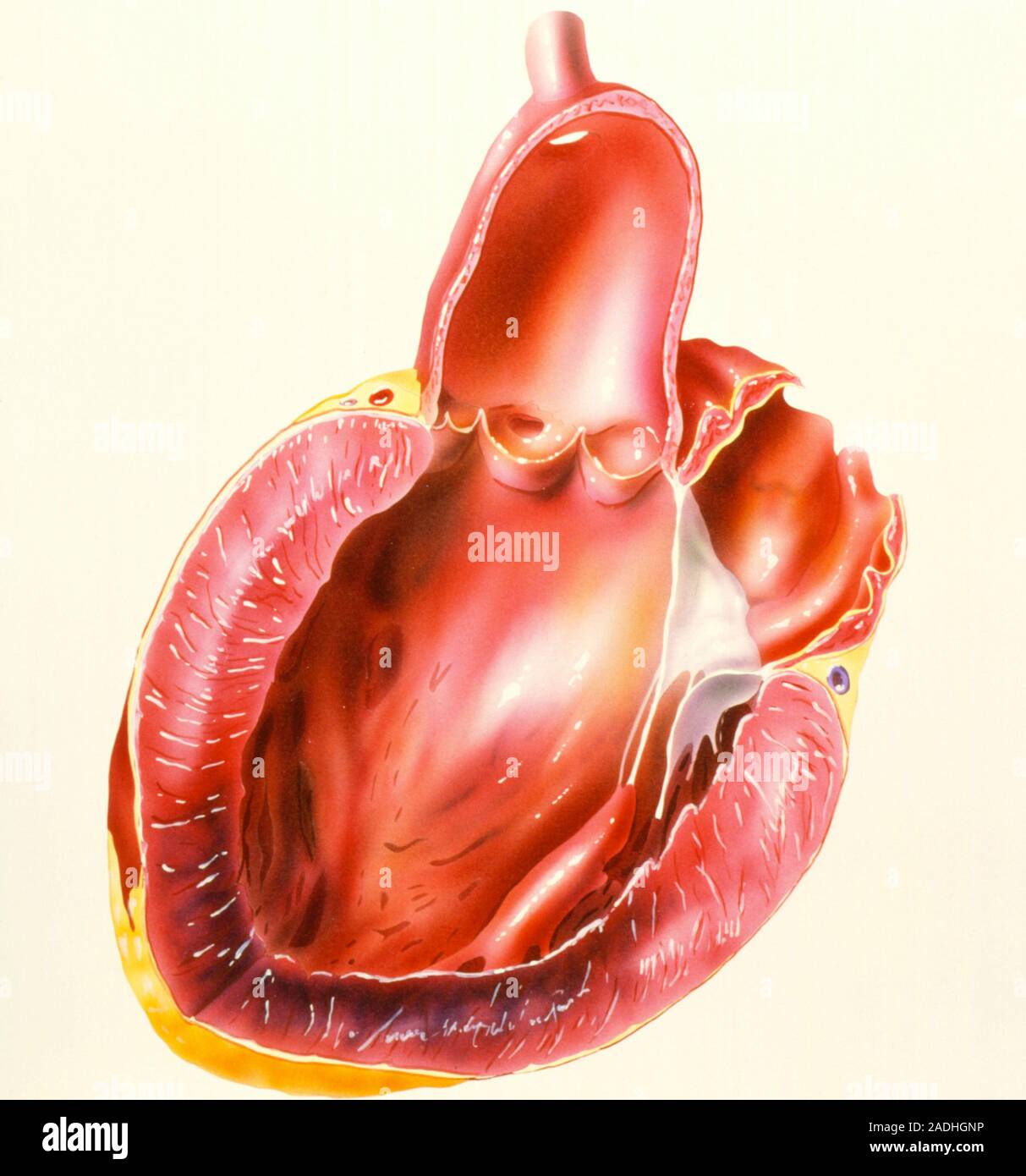 Heart attack. Illustration of a section through the human heart after ...